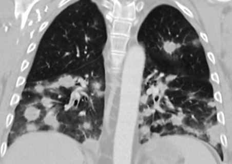 Multiple Nodules and Masses | Radiology Key