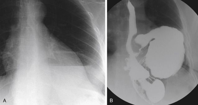 Solitary Lucent Defect | Radiology Key