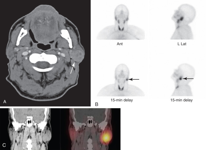 Thyroid, Parathyroid, and Salivary Glands | Radiology Key