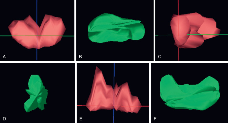 Thymus | Radiology Key