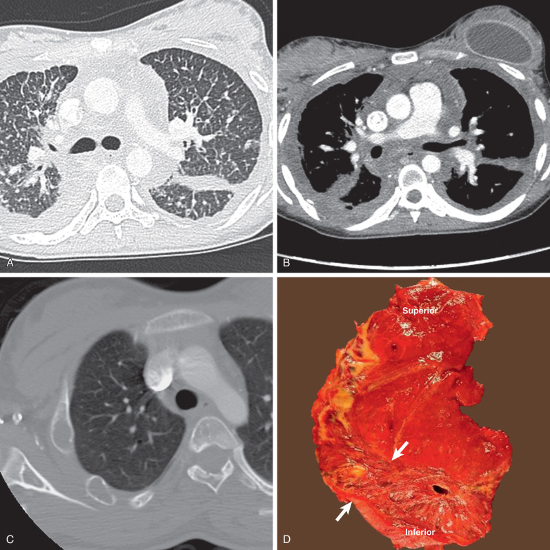 Airway and Parenchymal Anomalies | Radiology Key