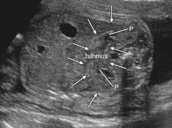 Abnormal Kidney Location | Radiology Key