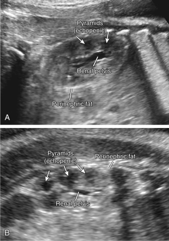 Abnormal Kidney Size | Radiology Key