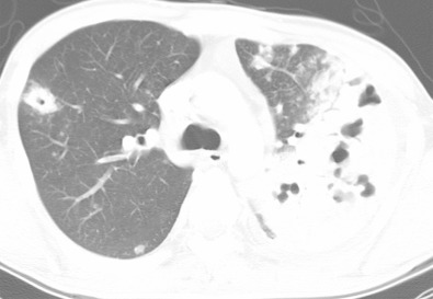 Pulmonary Tuberculosis | Radiology Key