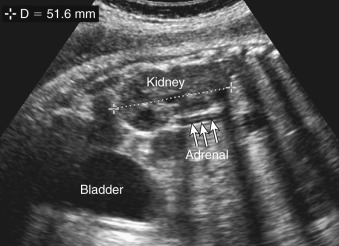 Unilateral Renal Agenesis | Radiology Key