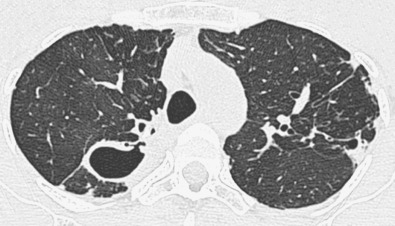 Nontuberculous (Atypical) Mycobacterial Infection | Radiology Key