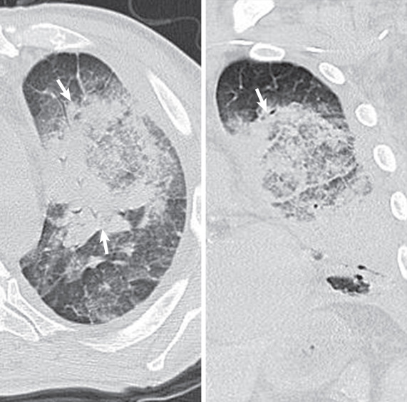 Fungal Infections | Radiology Key