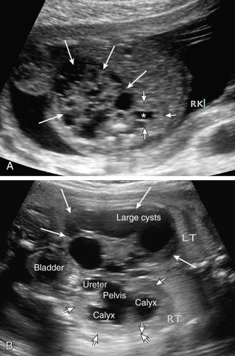 Multicystic Dysplastic Kidney | Radiology Key