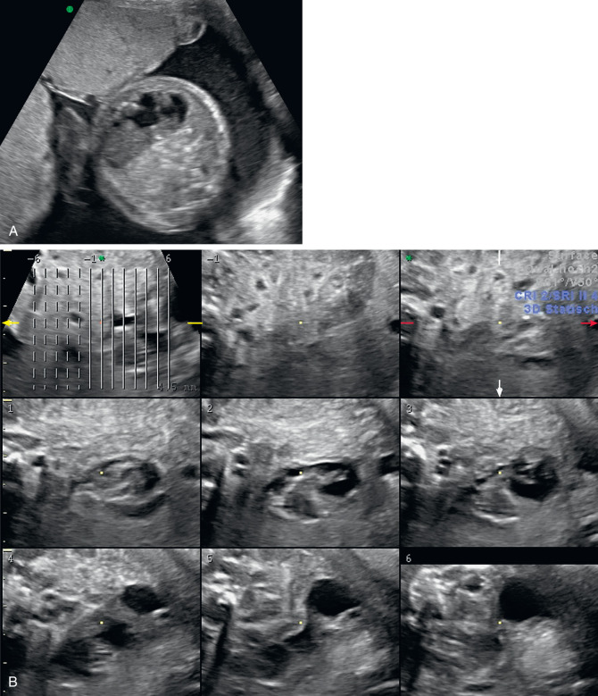 Intestinal Obstruction | Radiology Key
