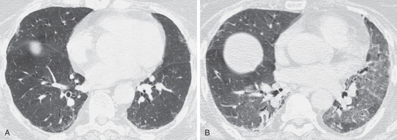 Usual Interstitial Pneumonia/Idiopathic Pulmonary Fibrosis | Radiology Key