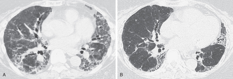 Nonspecific Interstitial Pneumonia | Radiology Key