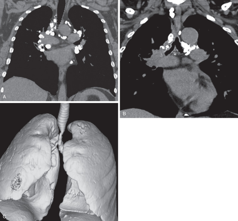 Pulmonary Metastases | Radiology Key