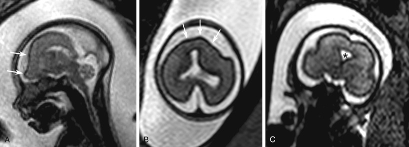 Corpus Callosum and Septum Pellucidum Anomalies | Radiology Key