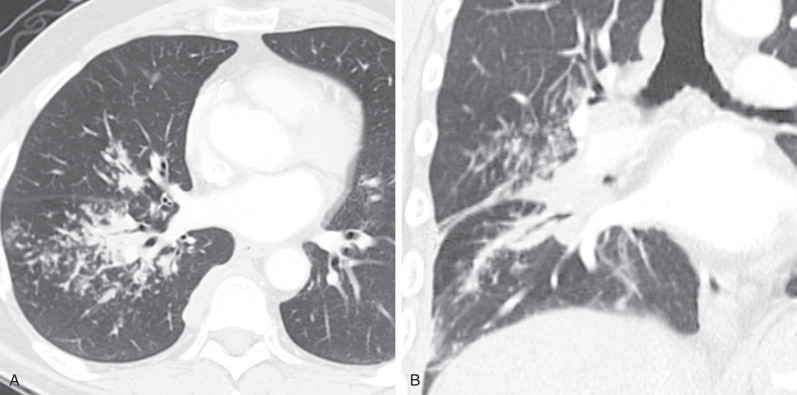 Pulmonary Metastases | Radiology Key