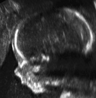 Chondrodysplasia Punctata | Radiology Key