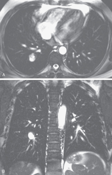Behçet Disease | Radiology Key