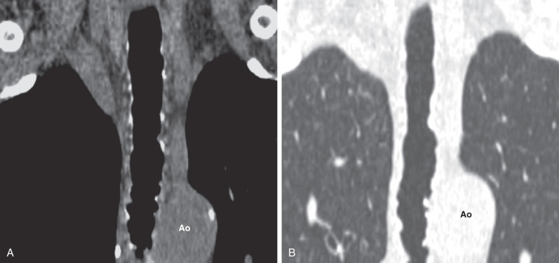 Tracheal Diseases | Radiology Key