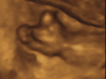 Abnormal Hands: Focus on the Thumbs | Radiology Key