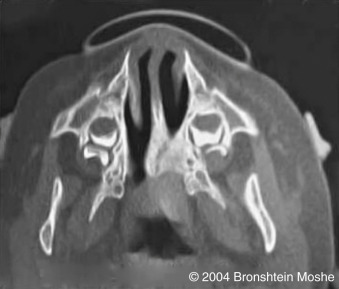 Choanal Atresia | Radiology Key