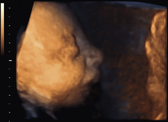 Micrognathia and Retrognathia | Radiology Key