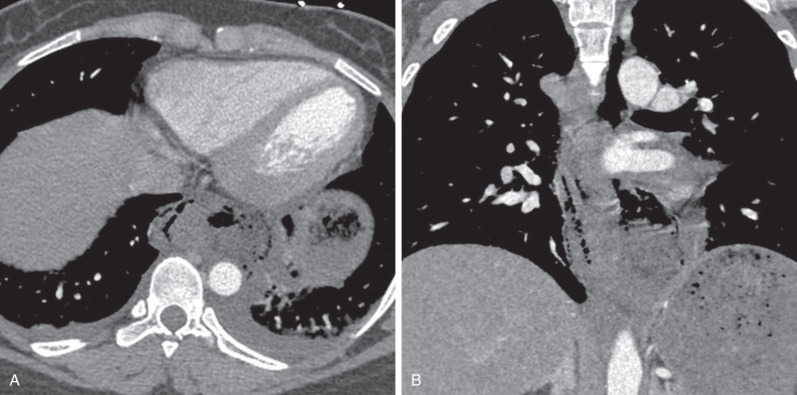 Pneumomediastinum | Radiology Key