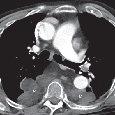 Mediastinal Masses | Radiology Key