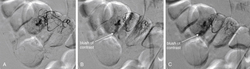 Abdominal Paracentesis Radiology Key