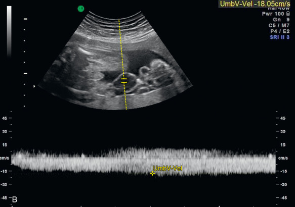 Cord Varix | Radiology Key
