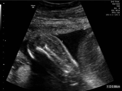 Nonimmune Hydrops Fetalis | Radiology Key