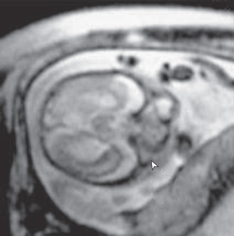 Goldenhar Syndrome | Radiology Key