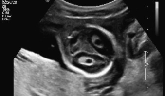 Turners Syndrome Ultrasound