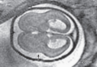 Miller-Dieker Syndrome (17p13.3 Deletion Syndrome) | Radiology Key