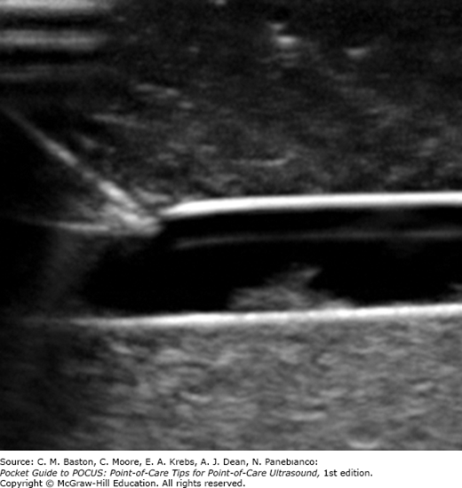 Ultrasound-Guided Internal Jugular Central Venous Catheterization (CVC ...