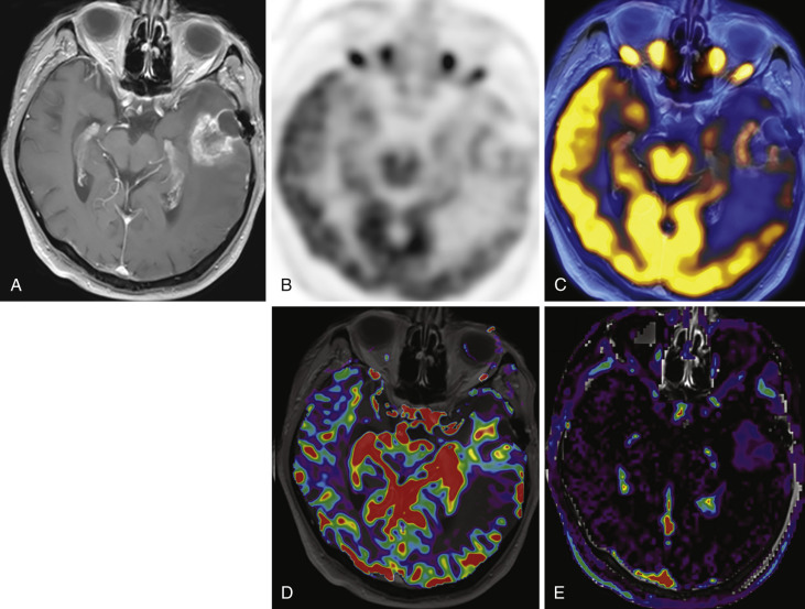 Intracranial Neoplasms | Radiology Key