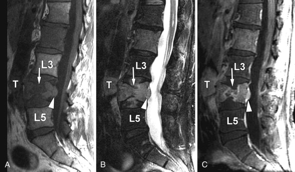 Burst Fracture | Radiology Key