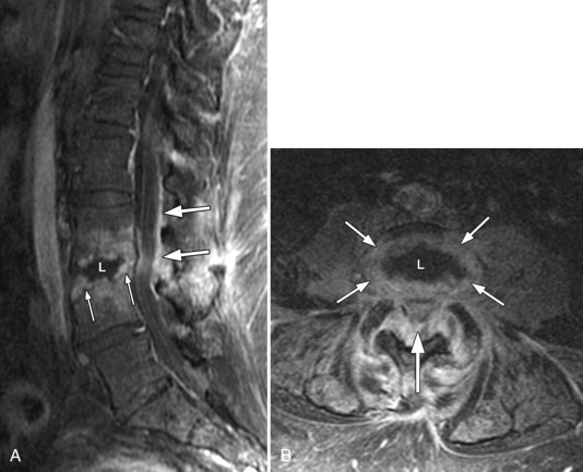 Cauda Equina Syndrome | Radiology Key
