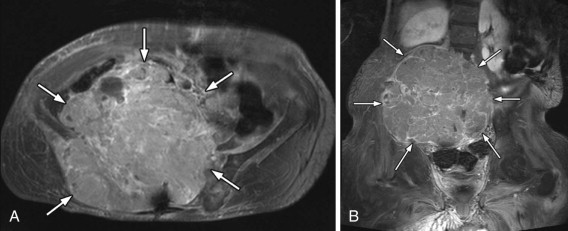 Schmorl’s Node | Radiology Key