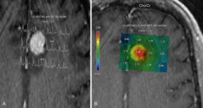 Brain Proton Magnetic Resonance Spectroscopy | Radiology Key