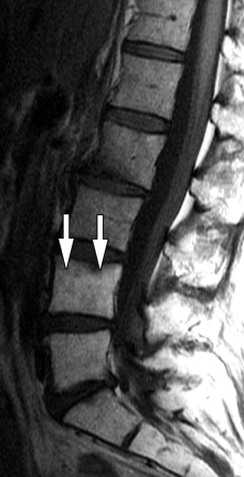 Degenerative Discogenic Vertebral Endplate Disease | Radiology Key