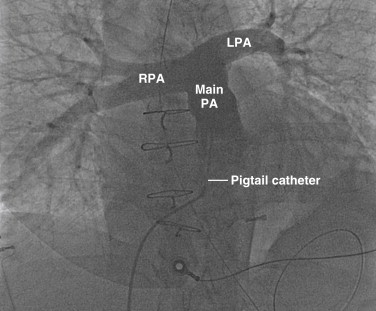Coronary Angiography: Technique | Radiology Key