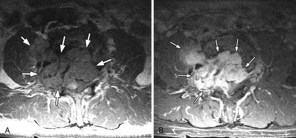 Disc Herniation—Foraminal | Radiology Key