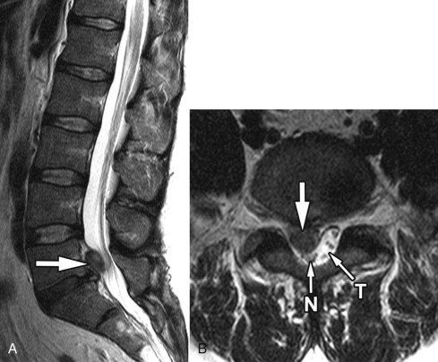 Epidural and Vertebral Metastases | Radiology Key