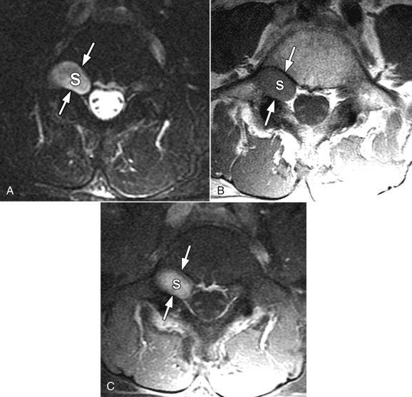 Ewing’s Sarcoma | Radiology Key