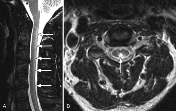 Inflammatory Polyneuropathy of the Cauda Equina | Radiology Key