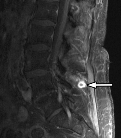 Interspinous Bursitis (Baastrup’s Disease) | Radiology Key