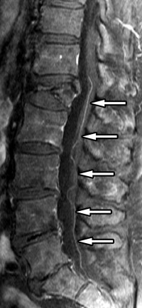 Intrathecal Radiculitis | Radiology Key