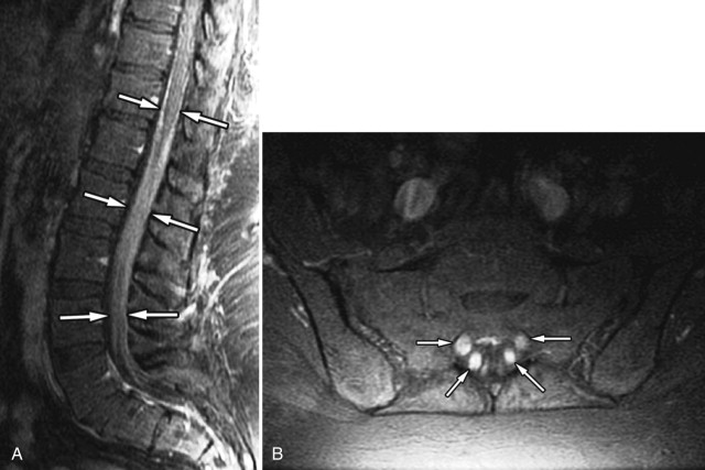 Leptomeningeal Metastasis | Radiology Key