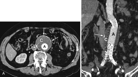 Lymphadenopathy | Radiology Key