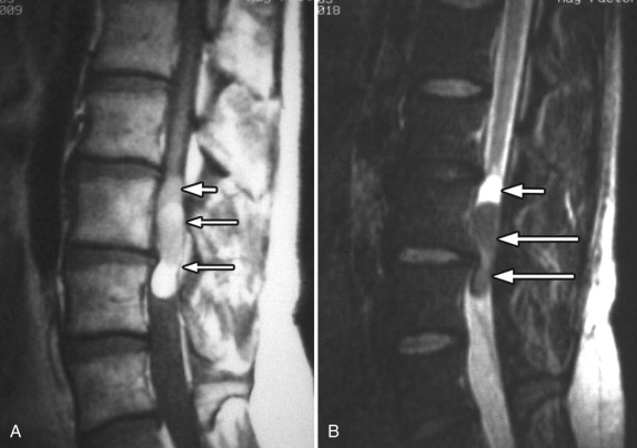 Vertebral Osteophytosis (Spondylosis Deformans) | Radiology Key