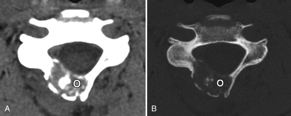 Osteochondroma | Radiology Key